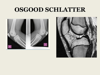 Osgood Schlatter | PDF