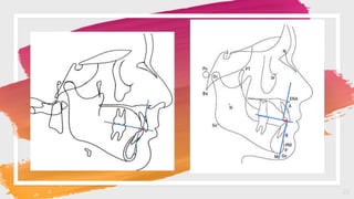 analisis angular- cefalometria medidas corregidas-2.pptx