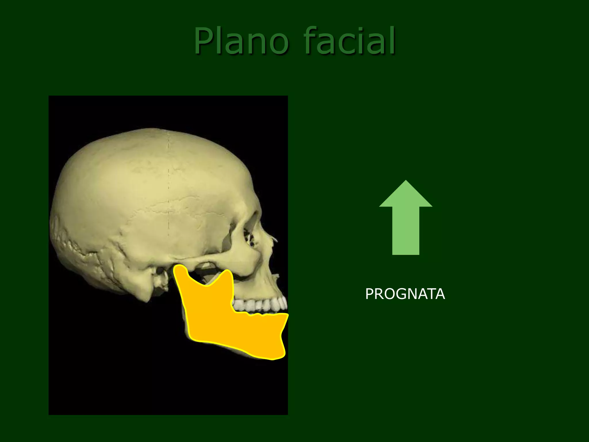Analisis de downs | PPTX | Dental Health | Diseases and Conditions