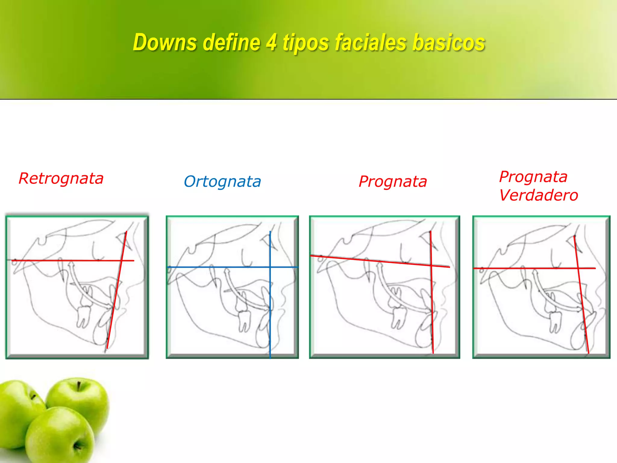 Analisis de downs | PPTX | Dental Health | Diseases and Conditions