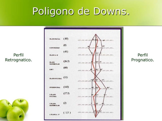 Analisis de downs | PPTX | Dental Health | Diseases and Conditions