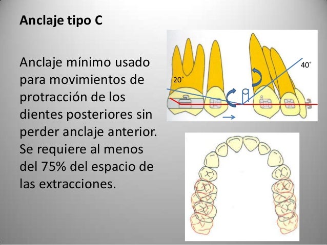 Analisis mecanico del anclaje