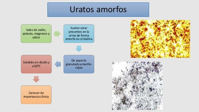 Analisis microscopico del sedimento urinario