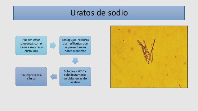 Analisis microscopico del sedimento urinario