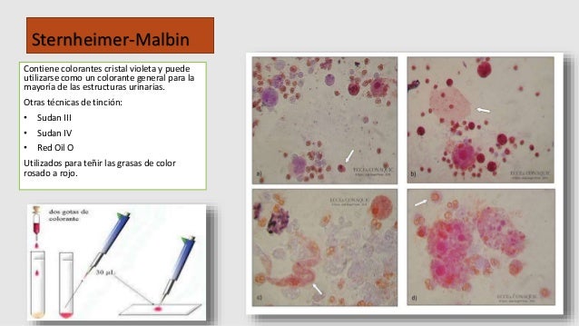 Analisis microscopico del sedimento urinario