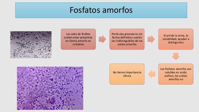 Analisis microscopico del sedimento urinario