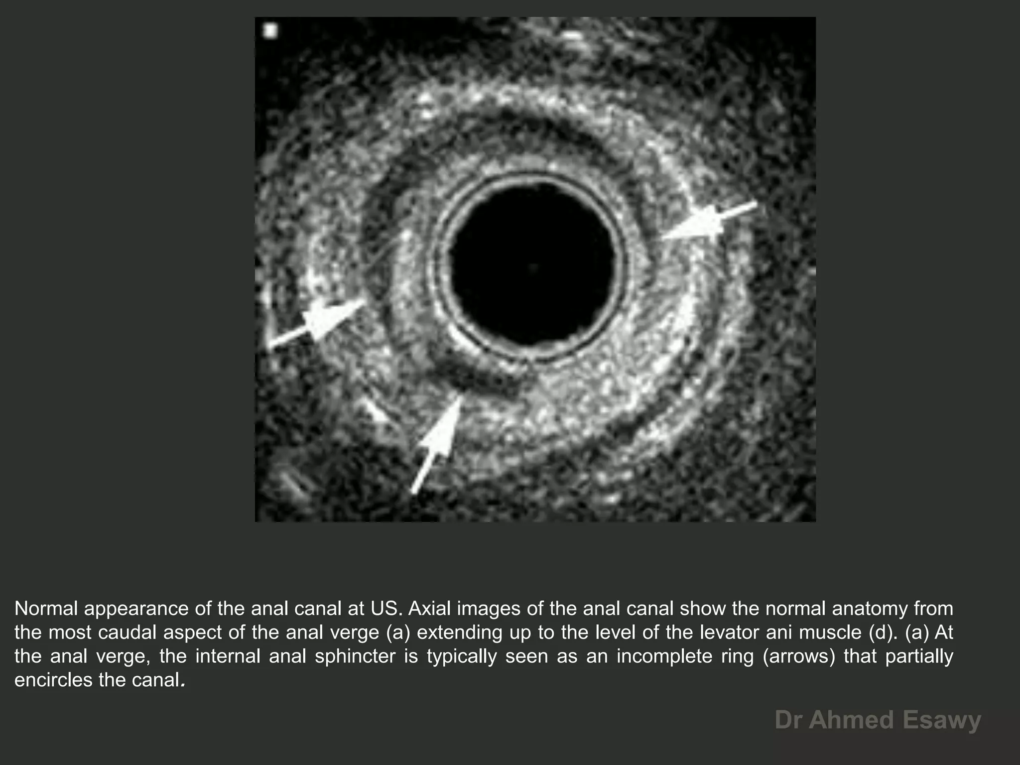 Anal perianal imaging part 1 CT MRI anatomy Dr Ahmed Esawy | PDF