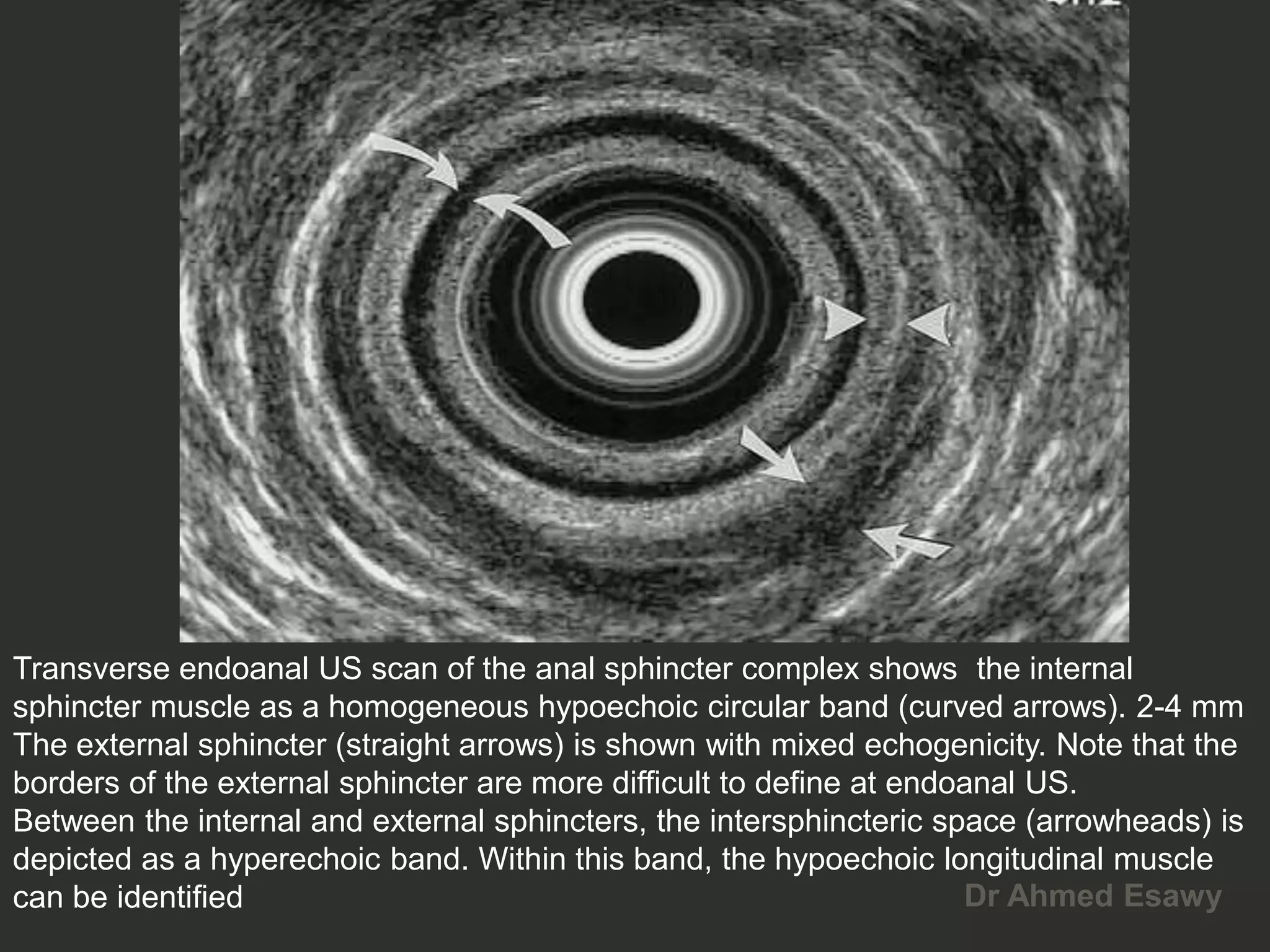 Anal perianal imaging part 1 CT MRI anatomy Dr Ahmed Esawy | PDF