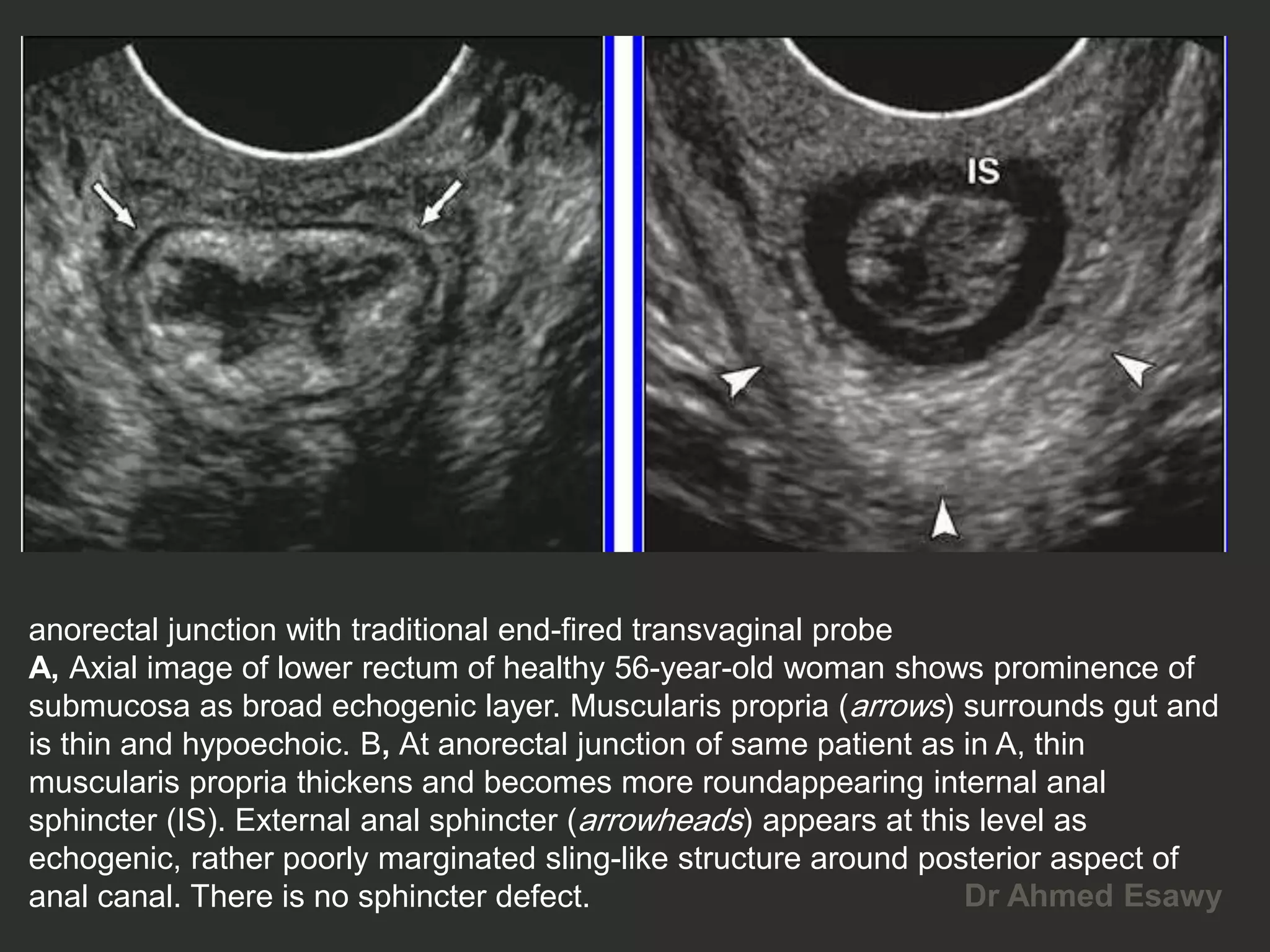 Anal perianal imaging part 1 CT MRI anatomy Dr Ahmed Esawy | PDF