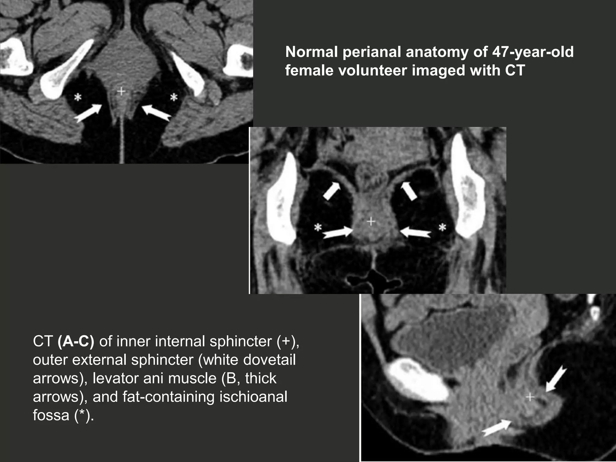 Anal perianal imaging part 1 CT MRI anatomy Dr Ahmed Esawy | PDF