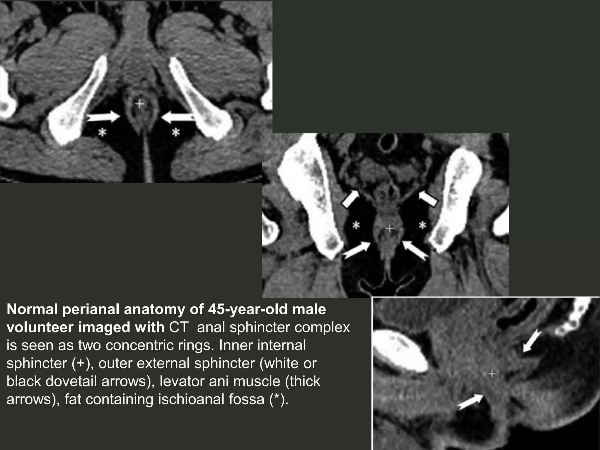 Anal perianal imaging part 1 CT MRI anatomy Dr Ahmed Esawy | PDF