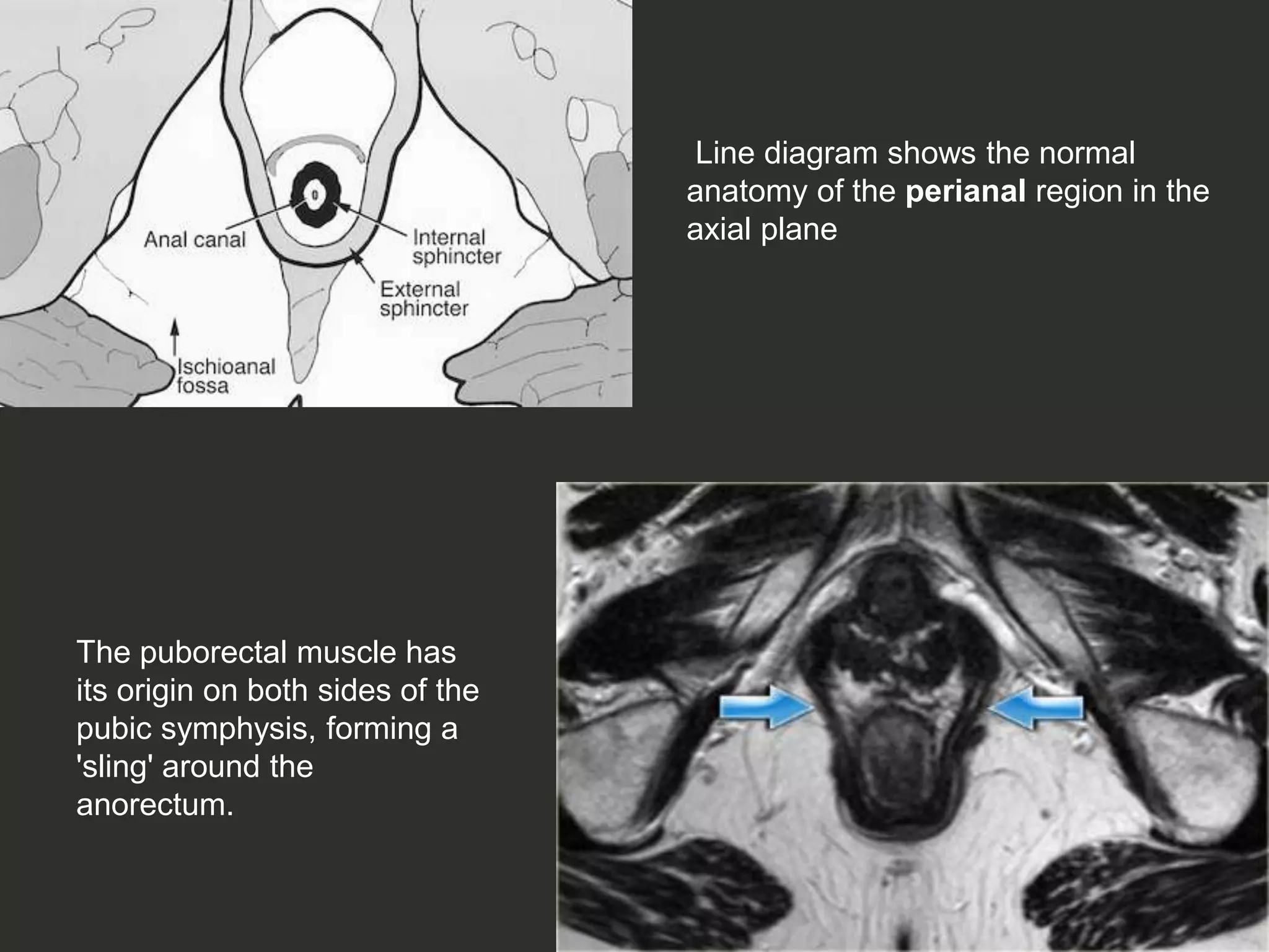 Anal perianal imaging part 1 CT MRI anatomy Dr Ahmed Esawy | PDF