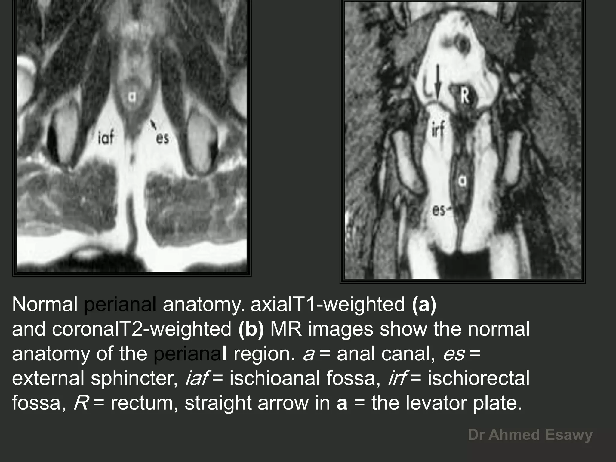 Anal perianal imaging part 1 CT MRI anatomy Dr Ahmed Esawy | PDF
