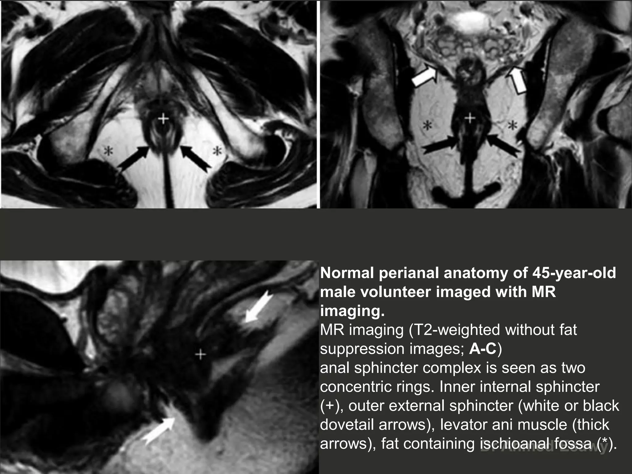 Anal perianal imaging part 1 CT MRI anatomy Dr Ahmed Esawy | PDF