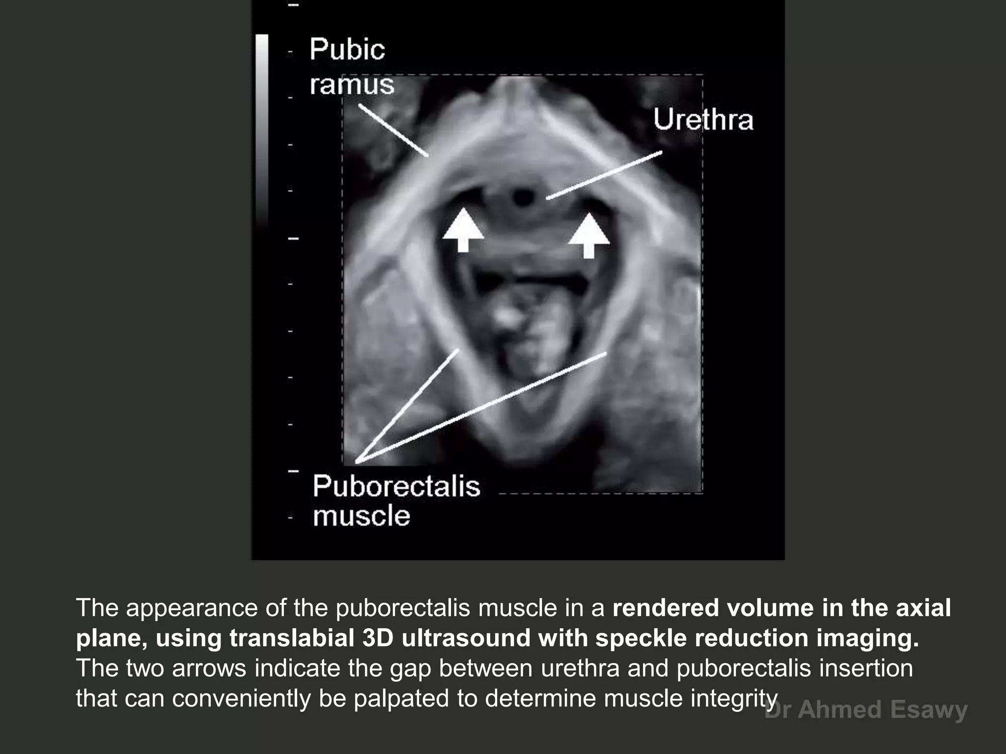 Anal perianal imaging part 1 CT MRI anatomy Dr Ahmed Esawy | PDF