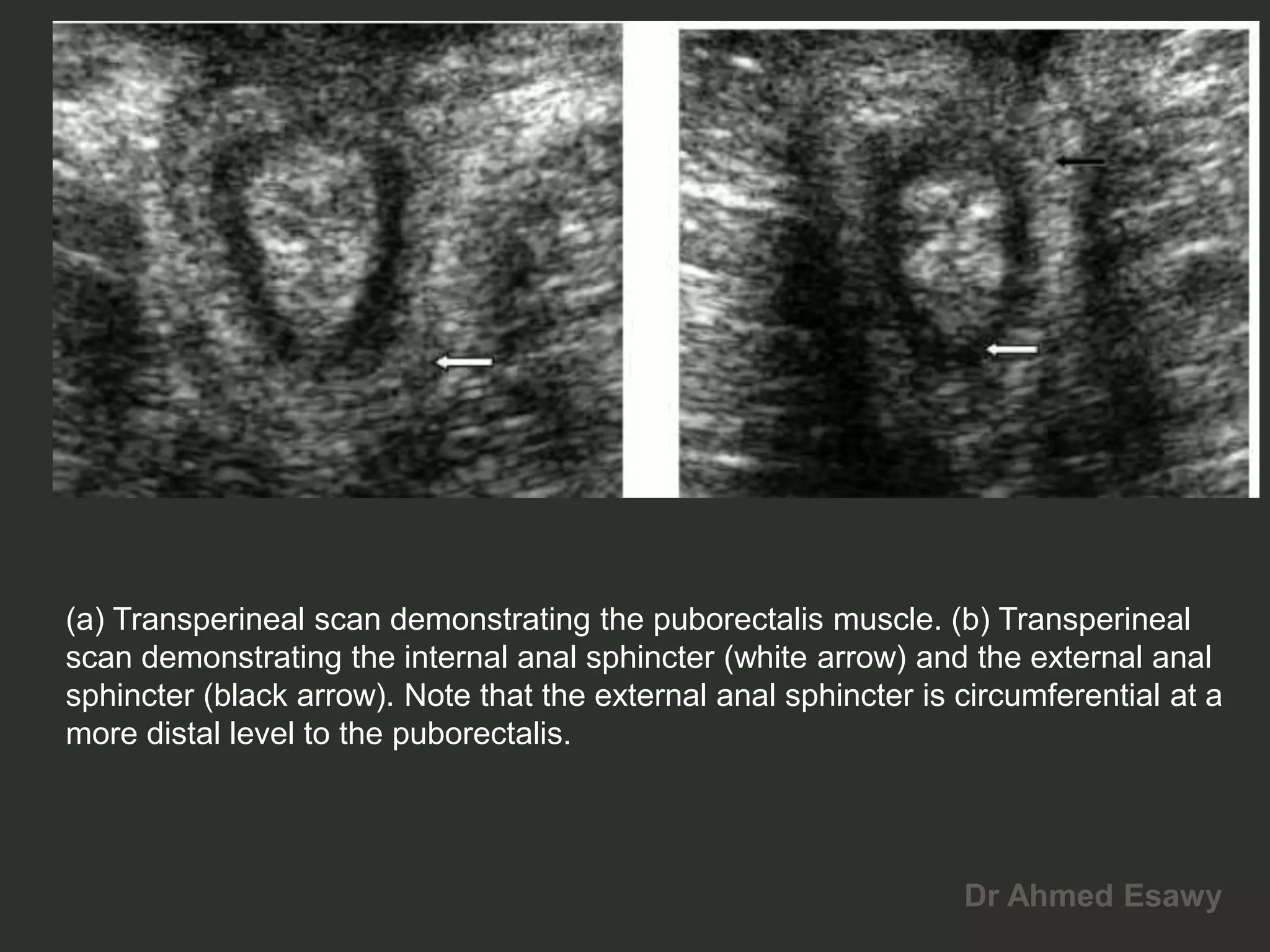 Anal perianal imaging part 1 CT MRI anatomy Dr Ahmed Esawy | PDF