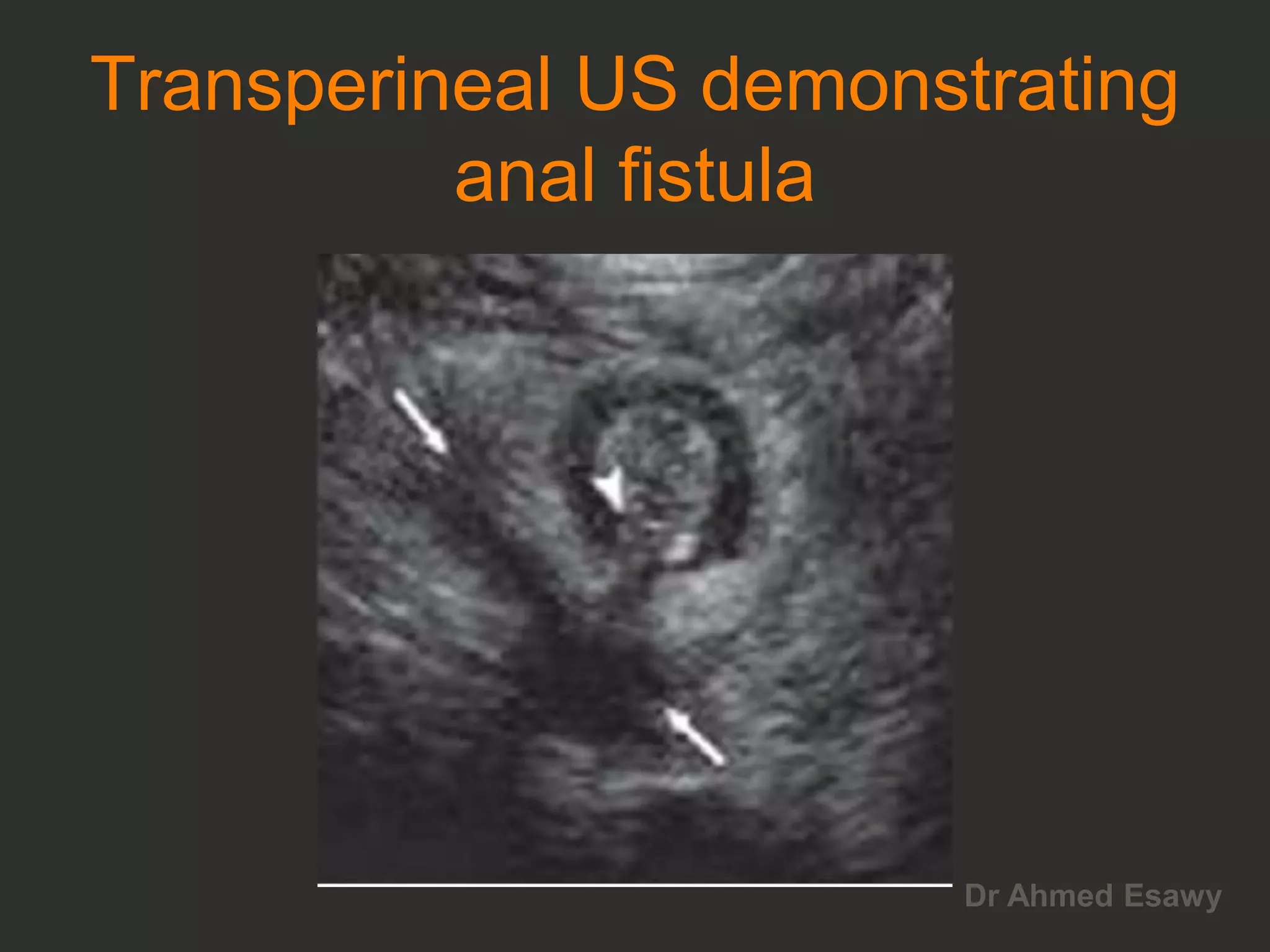 Anal perianal imaging part 1 CT MRI anatomy Dr Ahmed Esawy | PDF