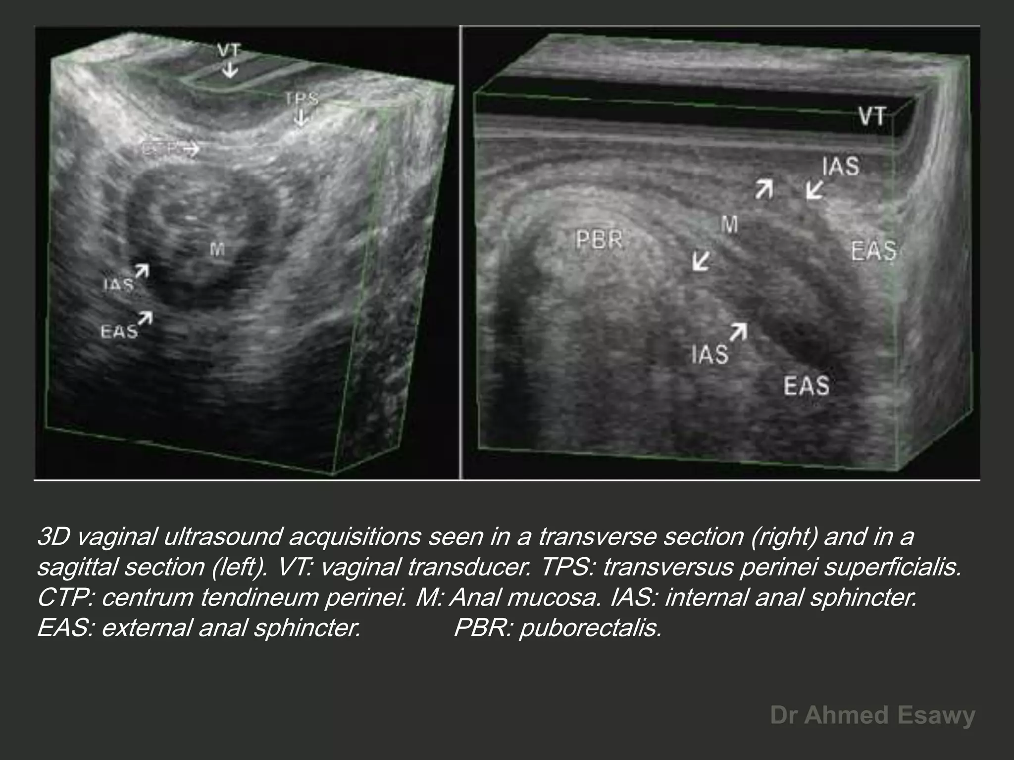 Anal perianal imaging part 1 CT MRI anatomy Dr Ahmed Esawy | PDF