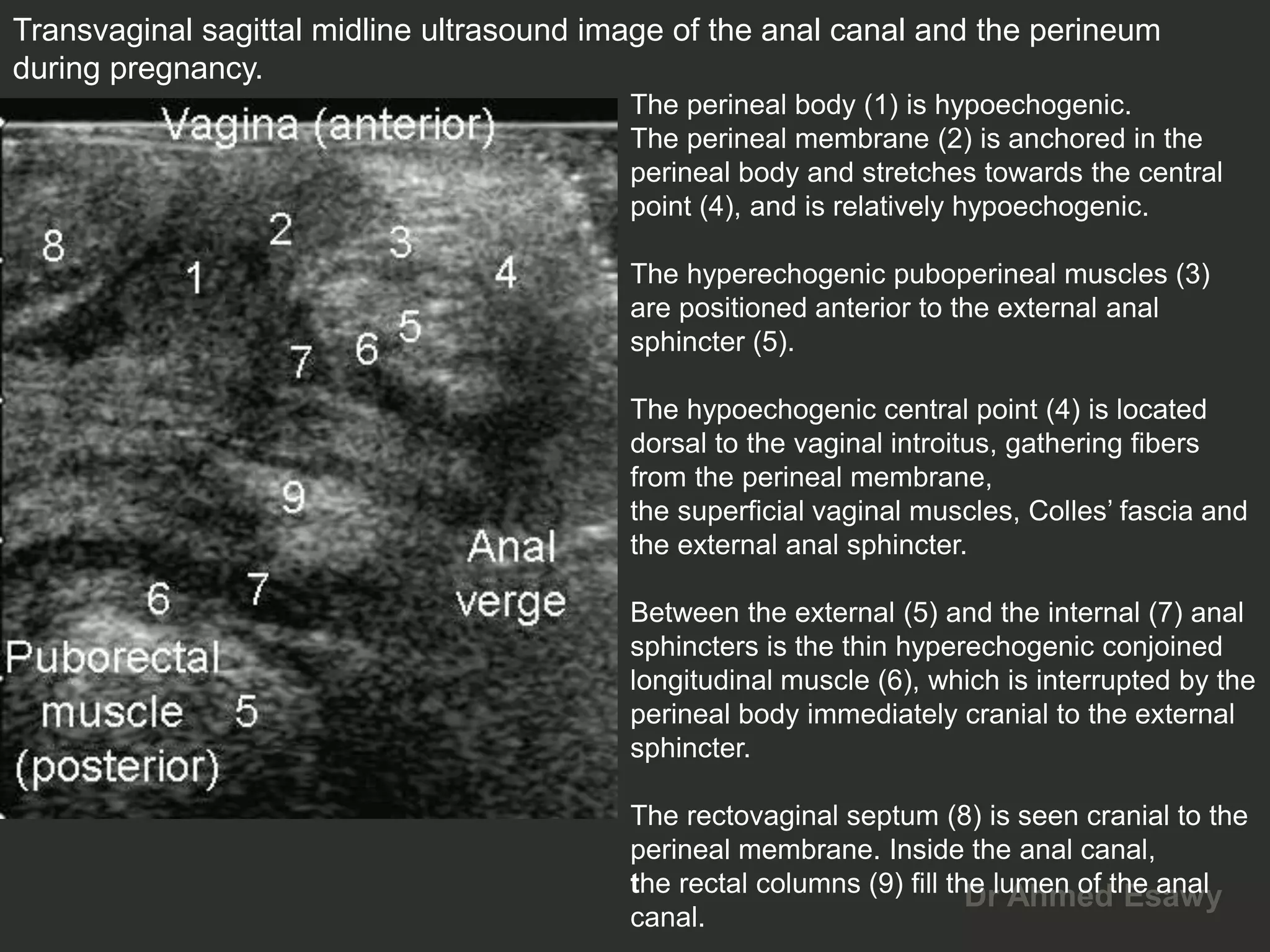 Anal perianal imaging part 1 CT MRI anatomy Dr Ahmed Esawy | PDF