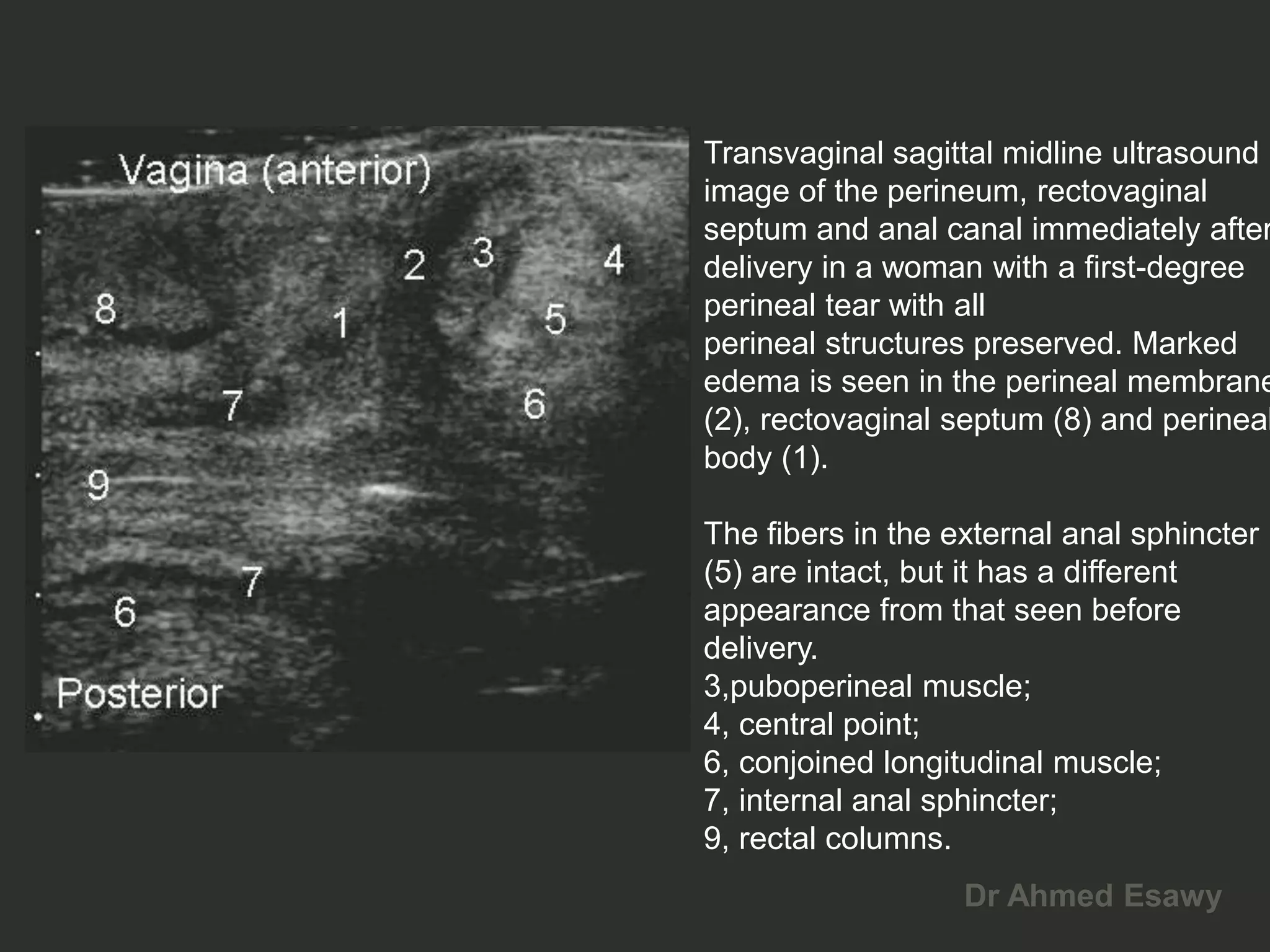 Anal perianal imaging part 1 CT MRI anatomy Dr Ahmed Esawy | PDF