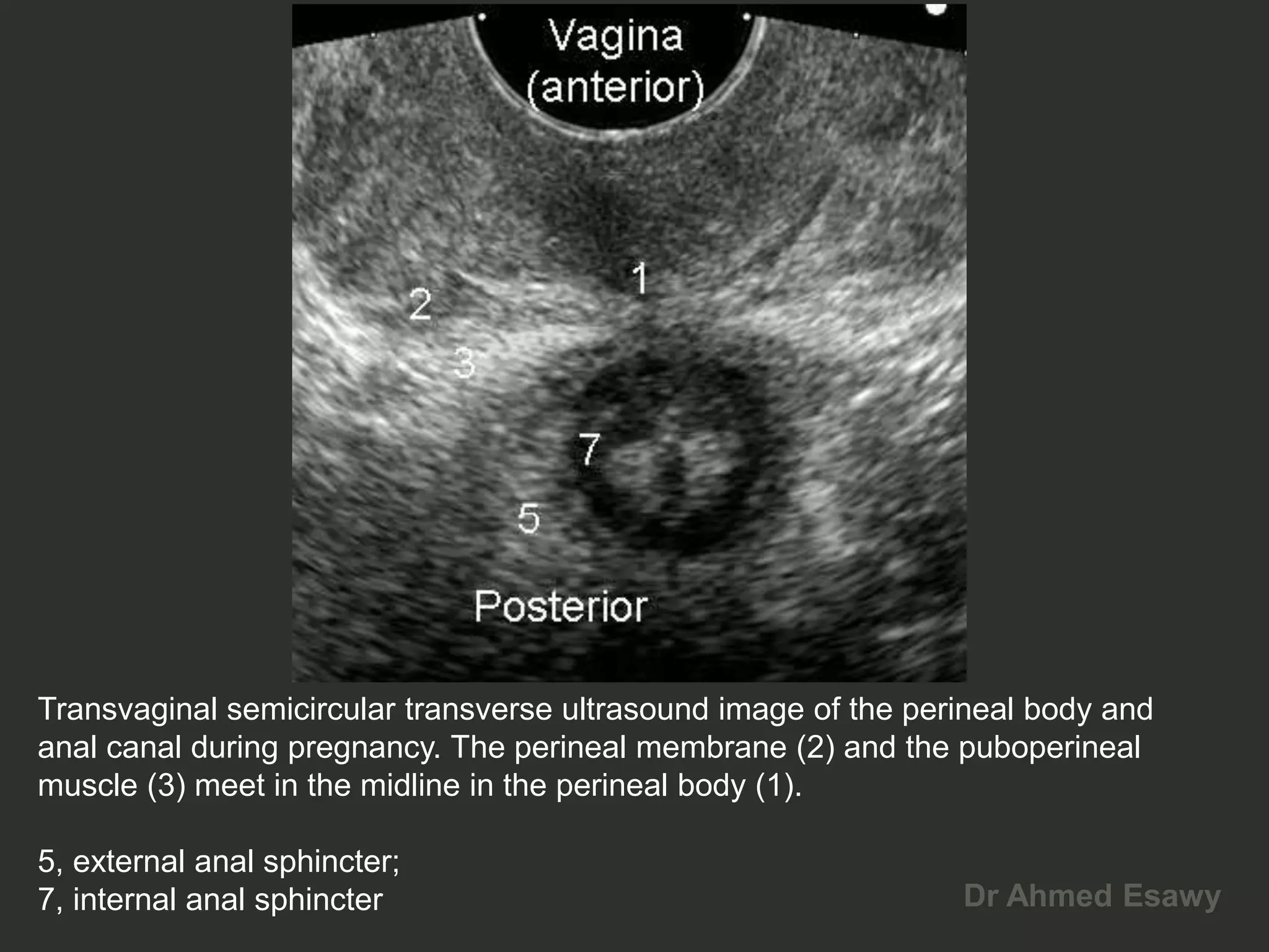 Anal perianal imaging part 1 CT MRI anatomy Dr Ahmed Esawy | PDF