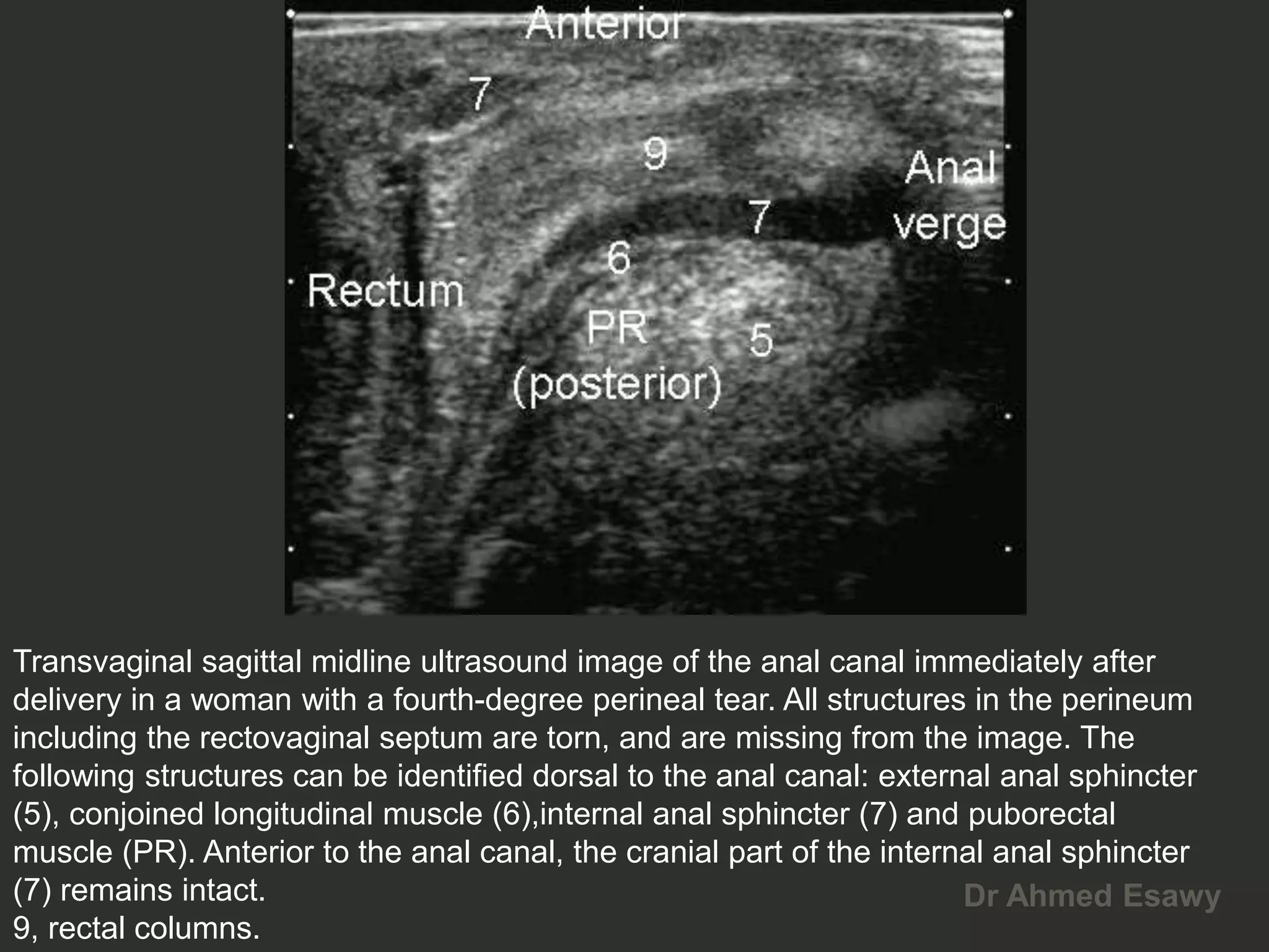 Anal perianal imaging part 1 CT MRI anatomy Dr Ahmed Esawy | PDF