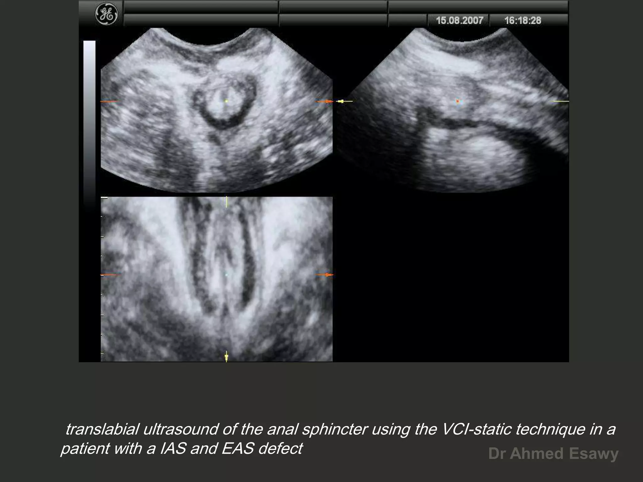 Anal perianal imaging part 1 CT MRI anatomy Dr Ahmed Esawy | PDF