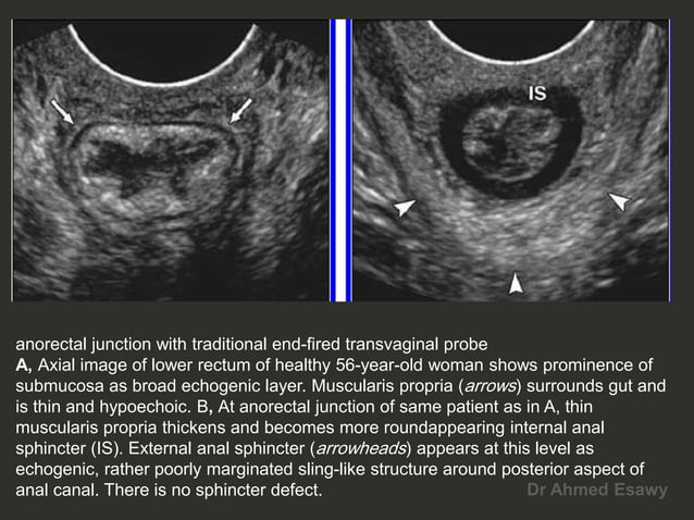 Anal perianal imaging part 1 CT MRI anatomy Dr Ahmed Esawy | PDF ...