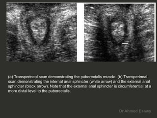 Anal perianal imaging part 1 CT MRI anatomy Dr Ahmed Esawy | PDF