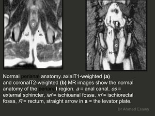 Ischiorectal Fossa Mri