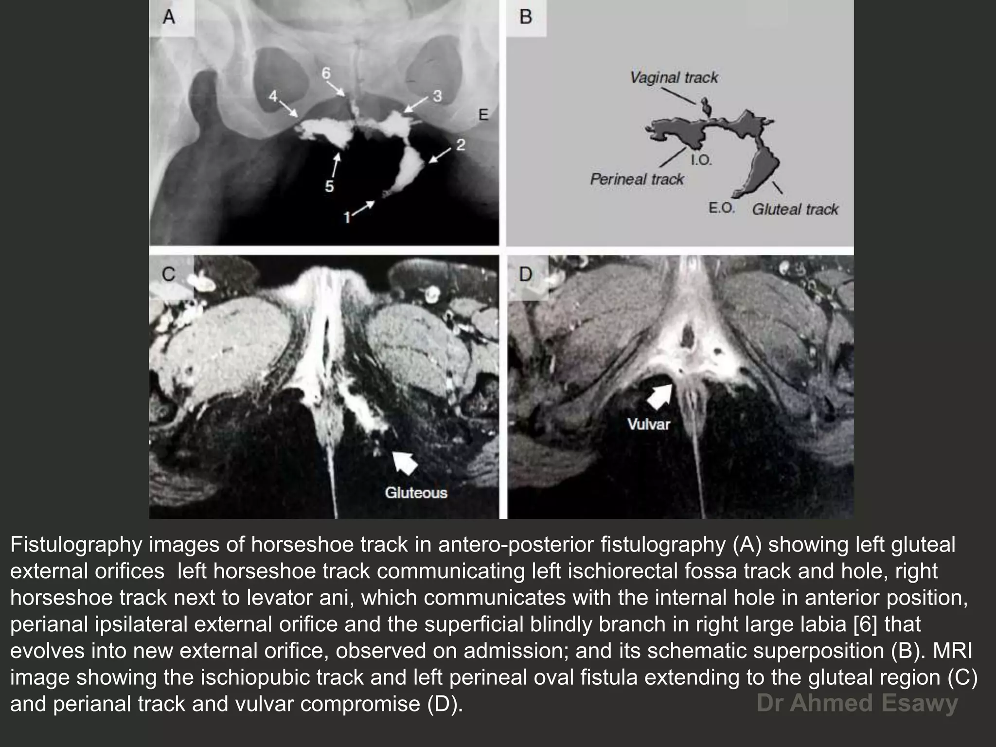 Anal perianal imaging part 2 perianal fistula CT MRI Dr Ahmed Esawy | PDF