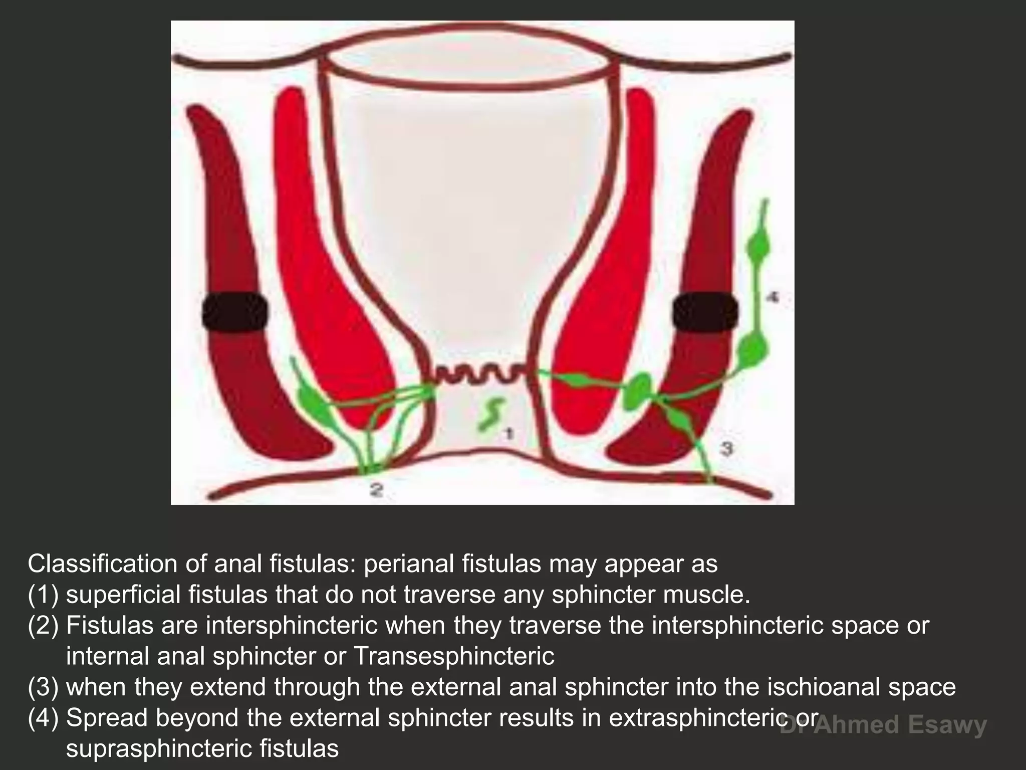 Anal perianal imaging part 2 perianal fistula CT MRI Dr Ahmed Esawy | PDF