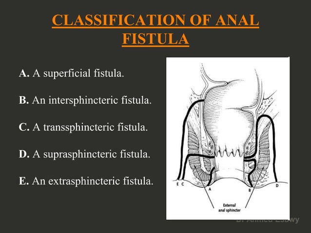 Anal perianal imaging part 2 perianal fistula CT MRI Dr Ahmed Esawy | PPT