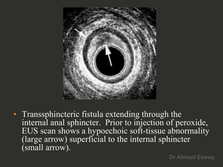 Anal perianal imaging part 2 perianal fistula CT MRI Dr Ahmed Esawy | PDF
