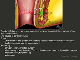 Anal perianal imaging part 2 perianal fistula CT MRI Dr Ahmed Esawy | PDF
