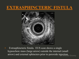 Anal perianal imaging part 2 perianal fistula CT MRI Dr Ahmed Esawy | PDF