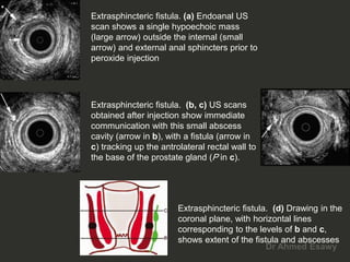 Anal perianal imaging part 2 perianal fistula CT MRI Dr Ahmed Esawy | PDF