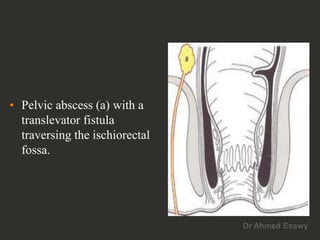 Anal perianal imaging part 2 perianal fistula CT MRI Dr Ahmed Esawy | PDF