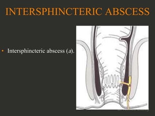 Anal perianal imaging part 2 perianal fistula CT MRI Dr Ahmed Esawy | PDF
