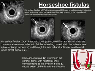 Horseshoe Perianal Abscess