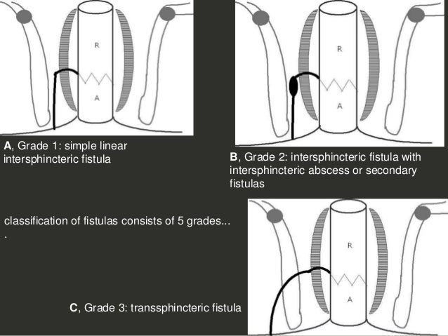 Anal perianal imaging part 2 perianal fistula CT MRI Dr Ahmed Esawy