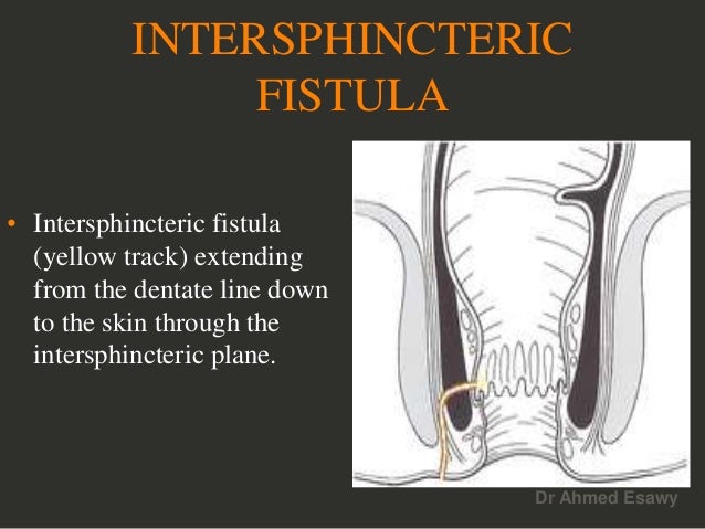 Anal perianal imaging part 2 perianal fistula CT MRI Dr Ahmed Esawy