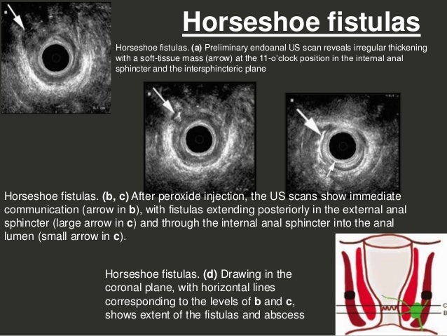 Anal perianal imaging part 2 perianal fistula CT MRI Dr Ahmed Esawy