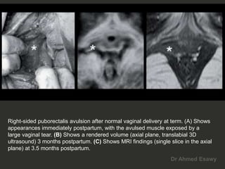 Anal perianal imaging part 3 anal tear CT MRI Dr Ahmed Esawy | PDF