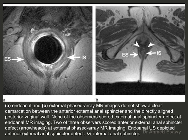 Anal perianal imaging part 4 in faecal continence CT MRI Dr Ahmed Esawy ...