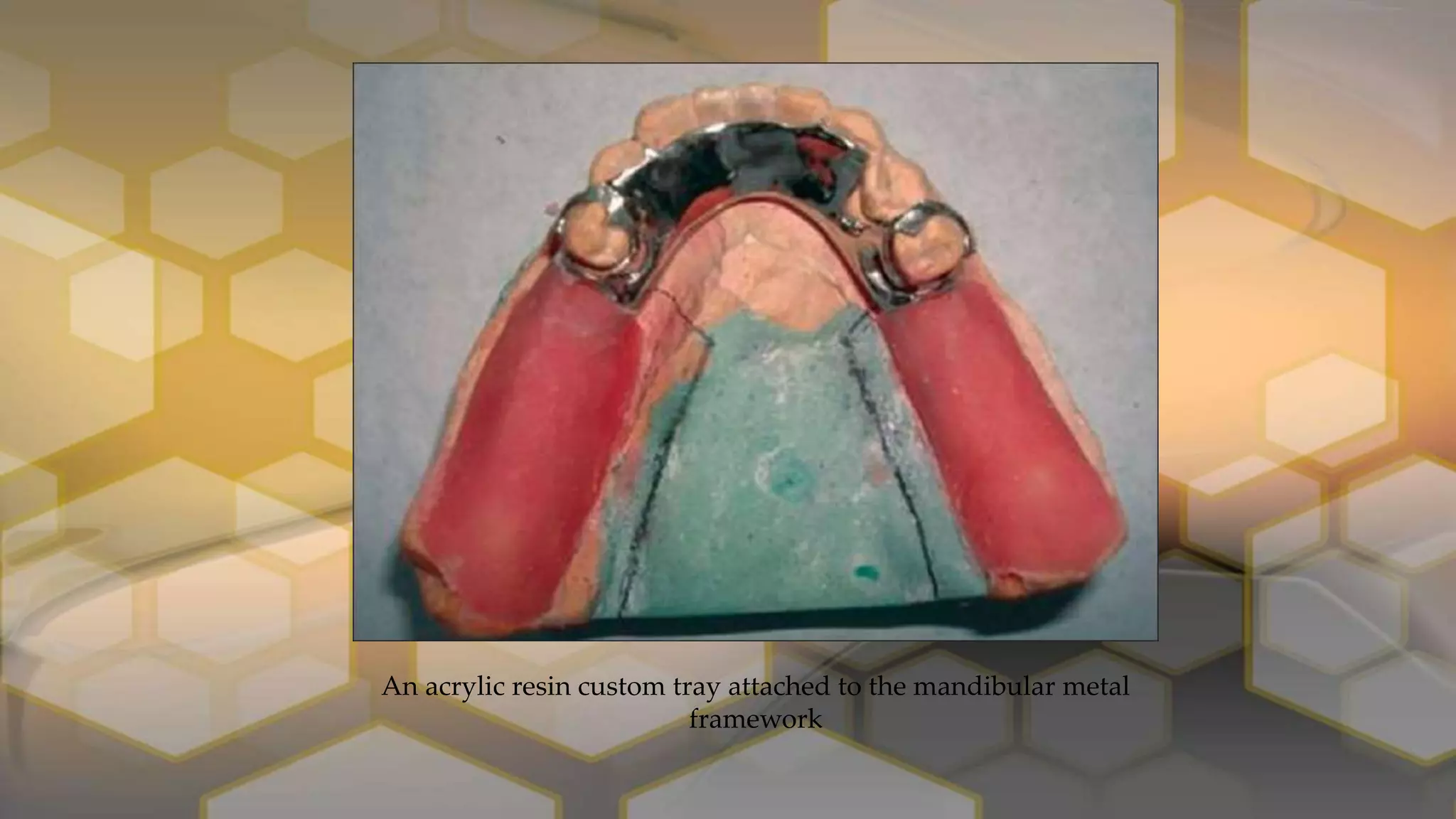 An altered cast procedure to improve tissue support | PPTX