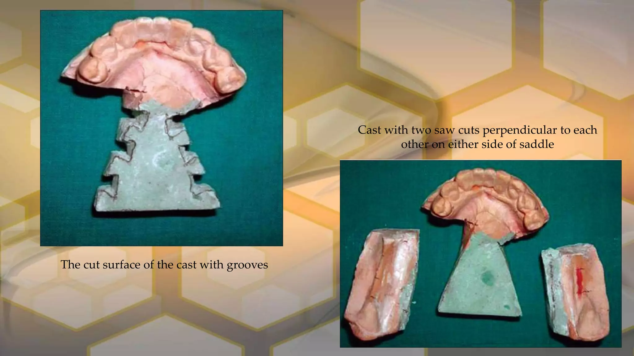 An altered cast procedure to improve tissue support | PPTX