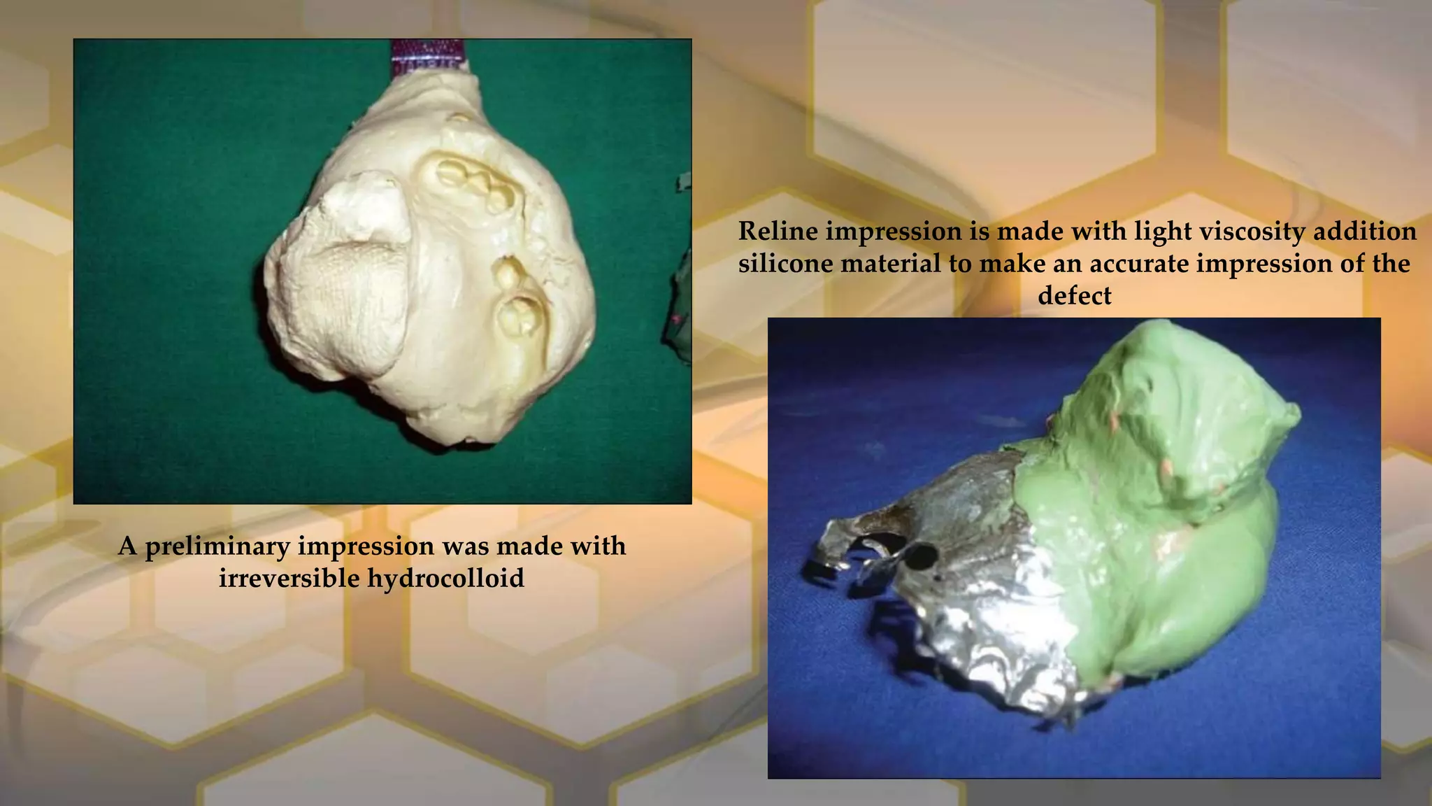 An altered cast procedure to improve tissue support | PPTX