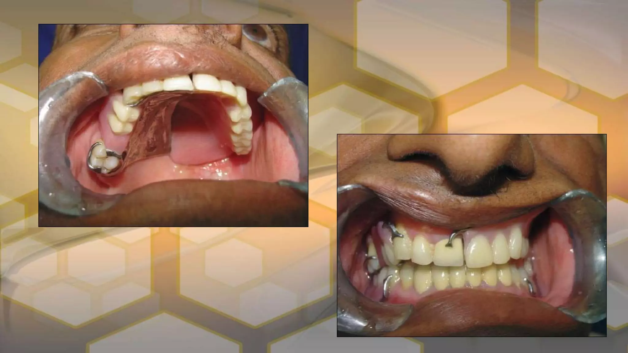 An altered cast procedure to improve tissue support | PPTX