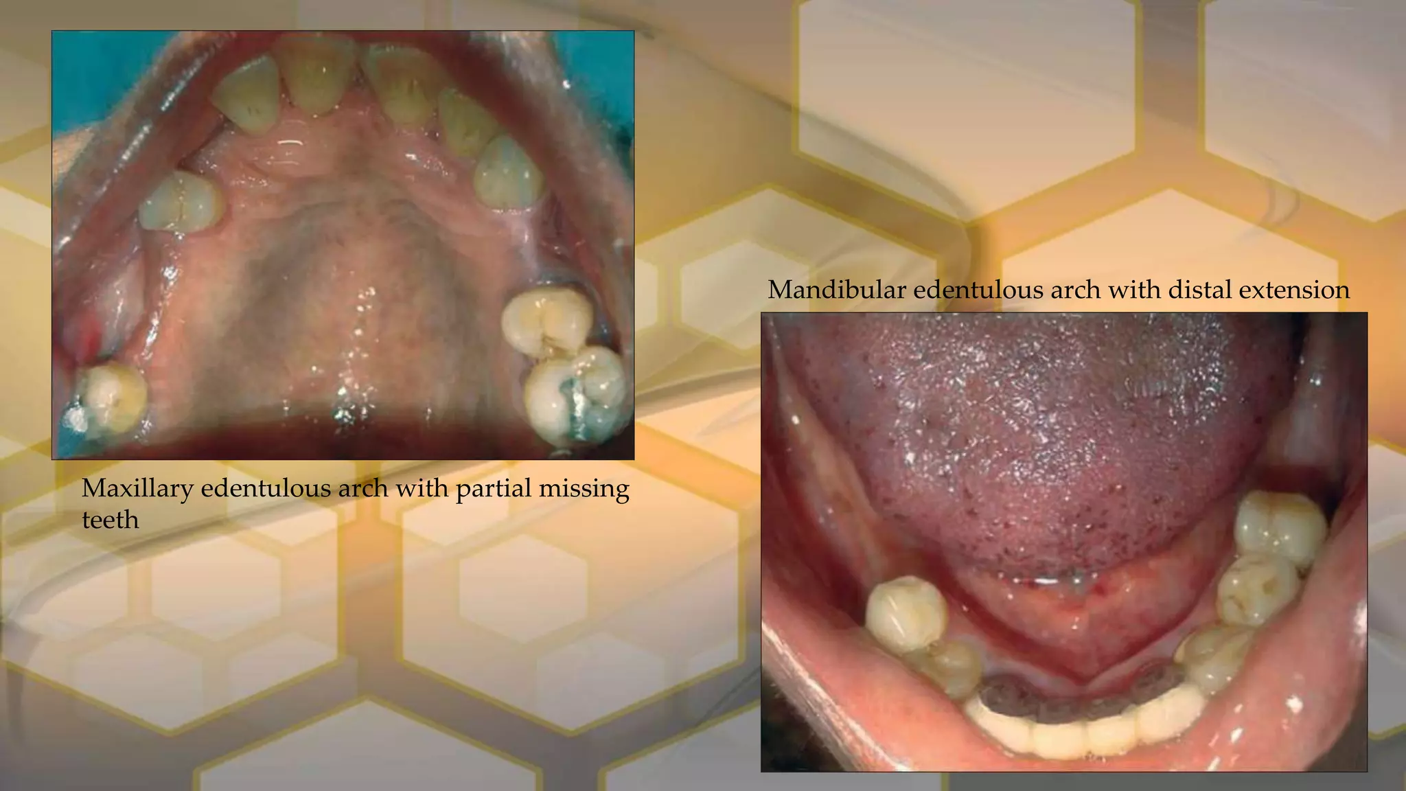 An altered cast procedure to improve tissue support | PPTX